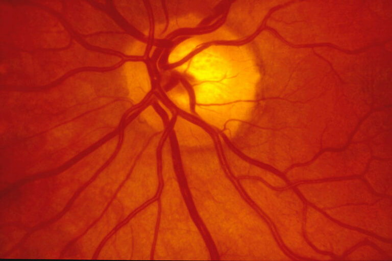 Retinal Vein Occlusions Columbus | Retina Condition West Point, GA